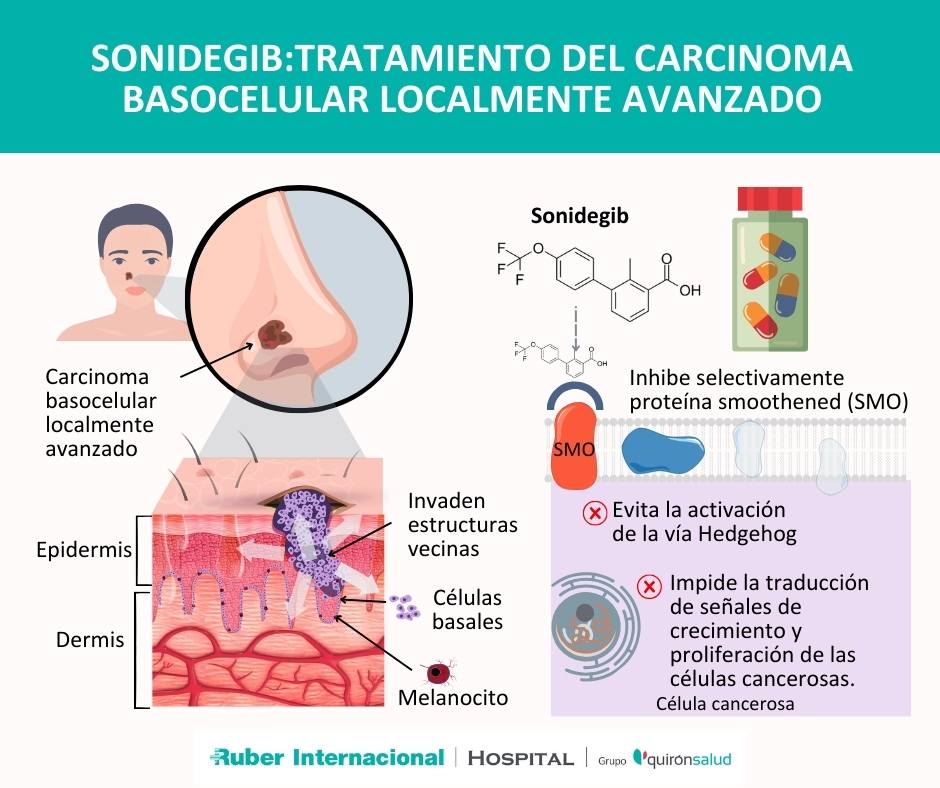 Tratamiento del Carcinoma de Células Basales: Sonidegib en Casos Avanzados